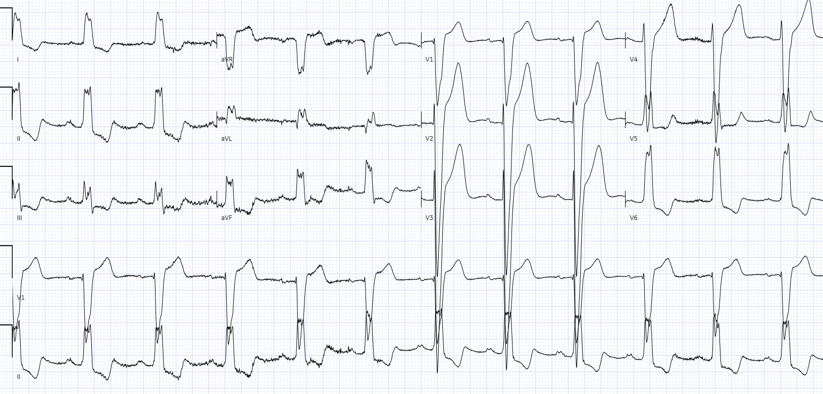 ECG Interpretation in Shortness of Breath | ECG Cases | EM Cases
