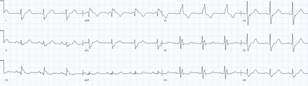 ECG Interpretation in Shortness of Breath | ECG Cases | EM Cases