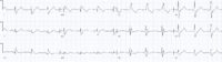 ECG Interpretation in Shortness of Breath | ECG Cases | EM Cases