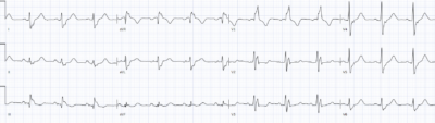 ECG Interpretation in Shortness of Breath | ECG Cases | EM Cases