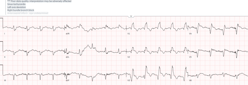 ECG Interpretation in Shortness of Breath | ECG Cases | EM Cases