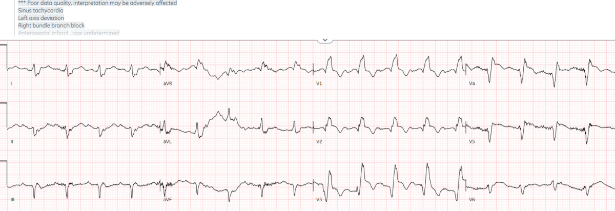 ECG Interpretation in Shortness of Breath | ECG Cases | EM Cases