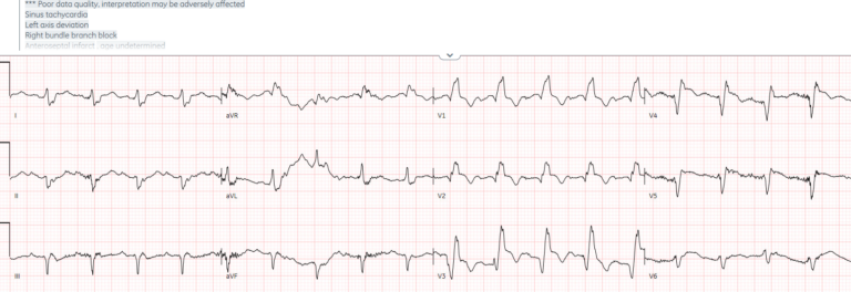 ECG Interpretation in Shortness of Breath | ECG Cases | EM Cases