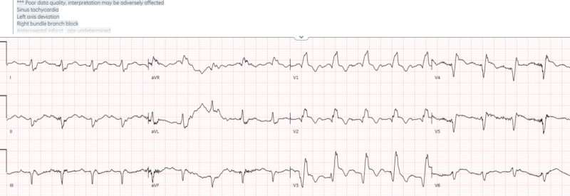 ECG Interpretation in Shortness of Breath | ECG Cases | EM Cases