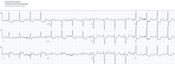 ECG Interpretation in Shortness of Breath | ECG Cases | EM Cases