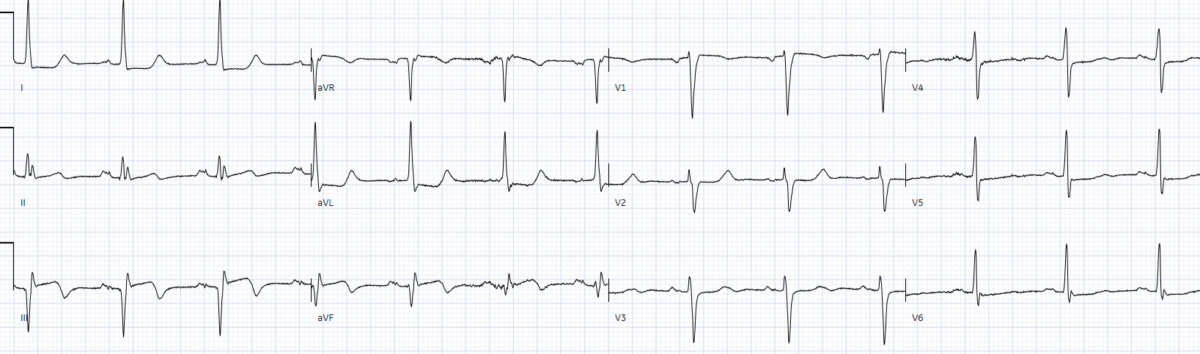 ECG Interpretation in Shortness of Breath | ECG Cases | EM Cases