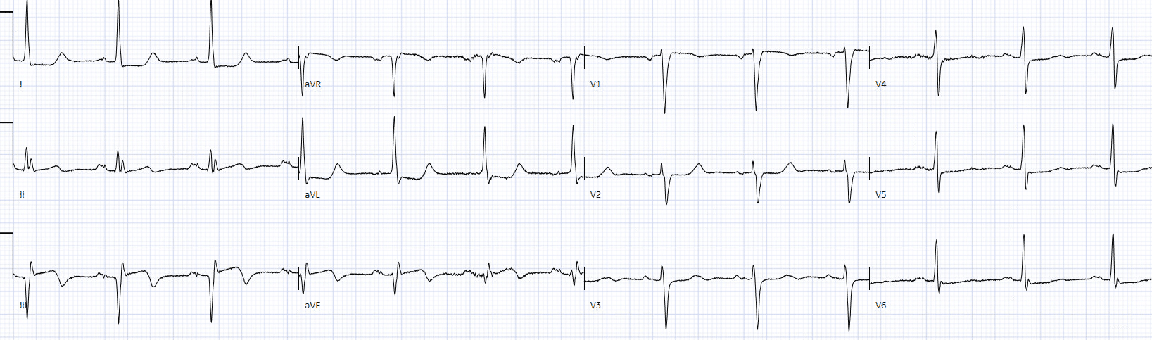 ECG Interpretation in Shortness of Breath | ECG Cases | EM Cases