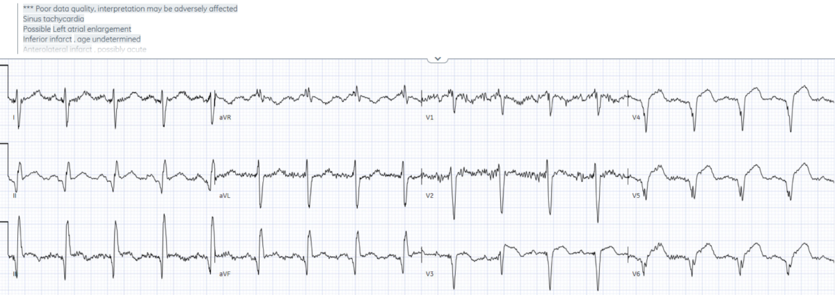 ECG Interpretation in Shortness of Breath | ECG Cases | EM Cases