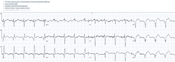 ECG Interpretation in Shortness of Breath | ECG Cases | EM Cases
