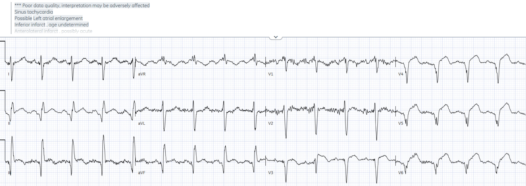 ECG Interpretation in Shortness of Breath | ECG Cases | EM Cases