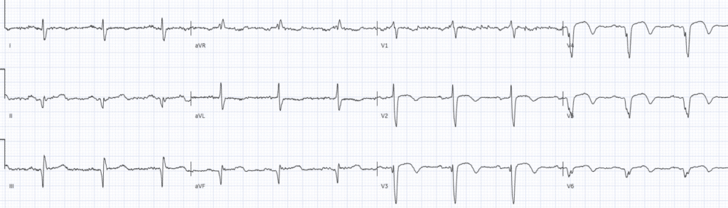ECG Interpretation in Shortness of Breath | ECG Cases | EM Cases