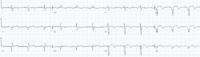 ECG Interpretation in Shortness of Breath | ECG Cases | EM Cases