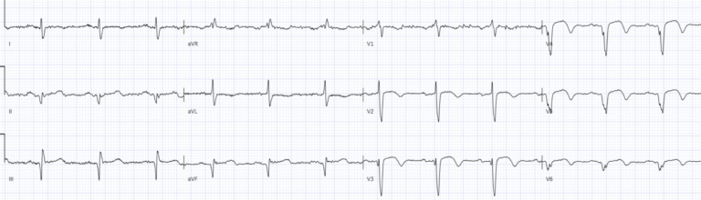 ECG Interpretation in Shortness of Breath | ECG Cases | EM Cases