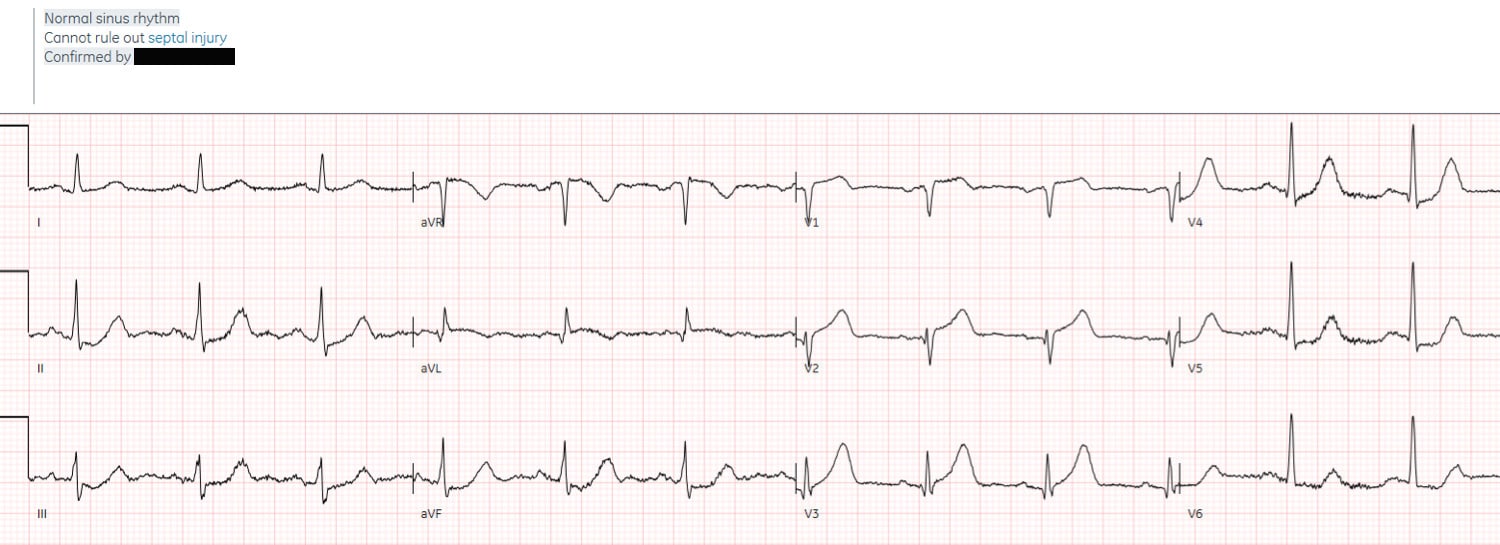 ECG interpretation in epigastric pain, vomiting | ECG Cases