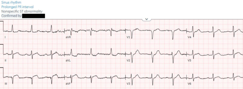 ECG interpretation in epigastric pain, vomiting | ECG Cases