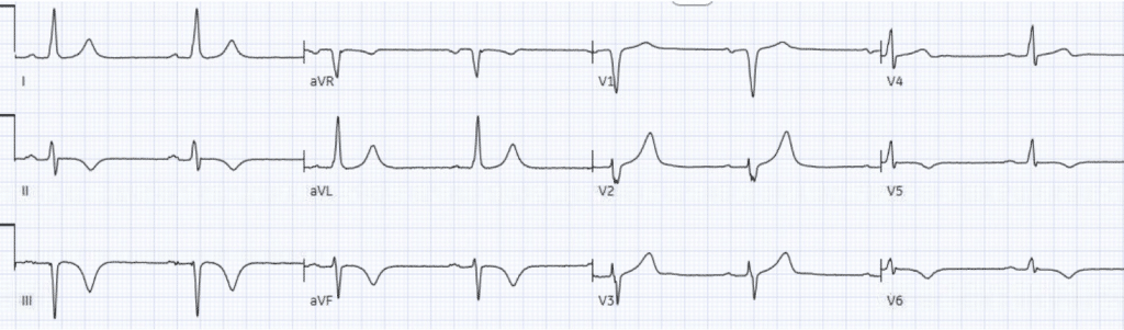 ECG interpretation in epigastric pain, vomiting | ECG Cases