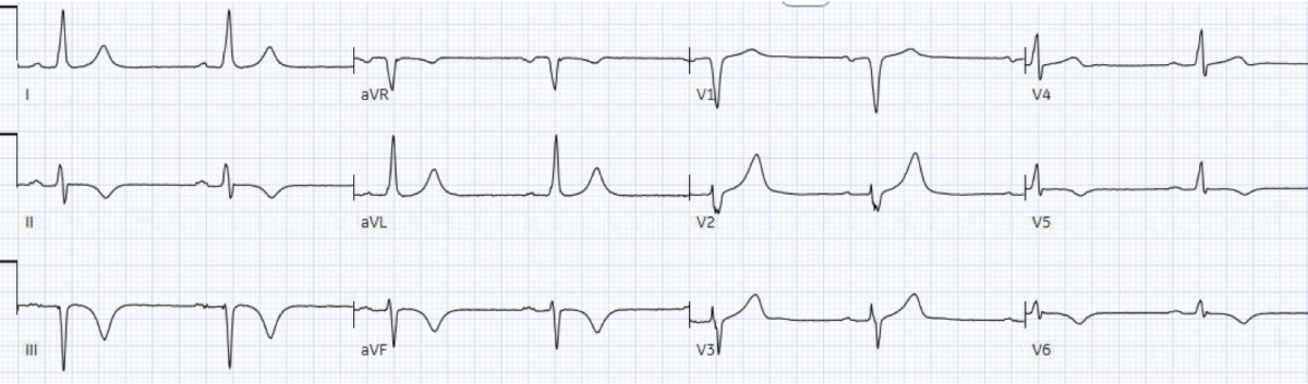 ECG interpretation in epigastric pain, vomiting | ECG Cases