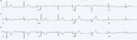 ECG interpretation in epigastric pain, vomiting | ECG Cases