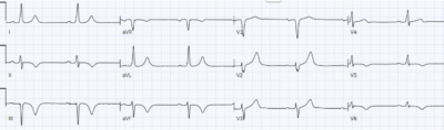 ECG interpretation in epigastric pain, vomiting | ECG Cases