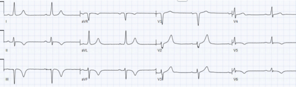 ECG interpretation in epigastric pain, vomiting | ECG Cases