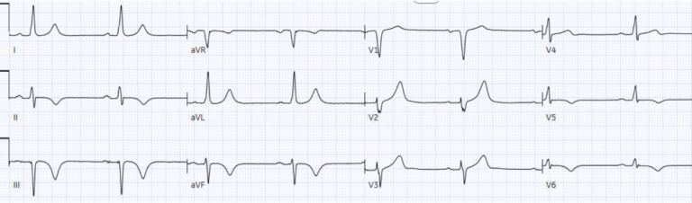 ECG interpretation in epigastric pain, vomiting | ECG Cases