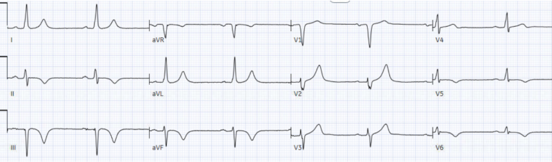 ECG interpretation in epigastric pain, vomiting | ECG Cases