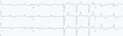 ECG interpretation in epigastric pain, vomiting | ECG Cases
