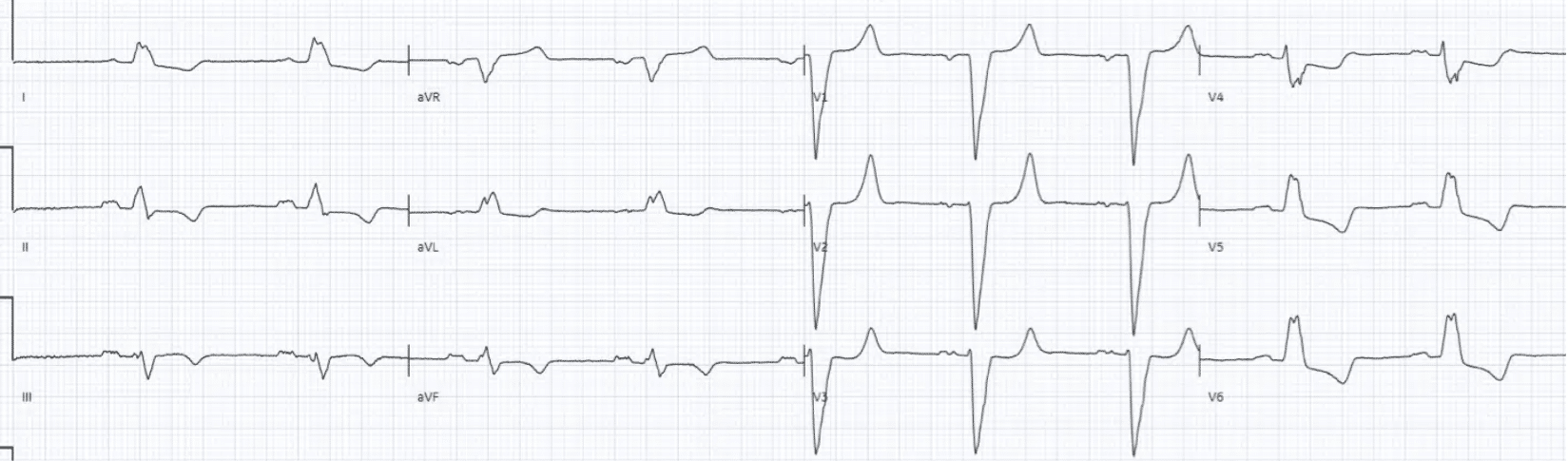 ECG interpretation in epigastric pain, vomiting | ECG Cases
