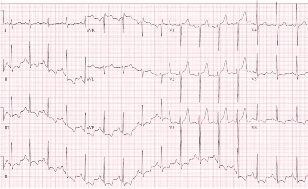 ECG interpretation in epigastric pain, vomiting | ECG Cases