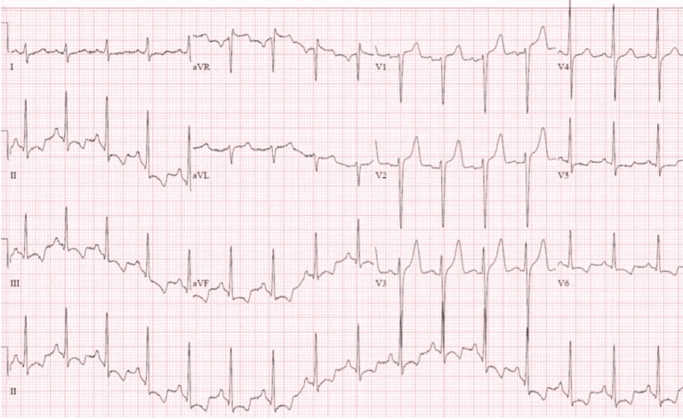 ECG interpretation in epigastric pain, vomiting | ECG Cases