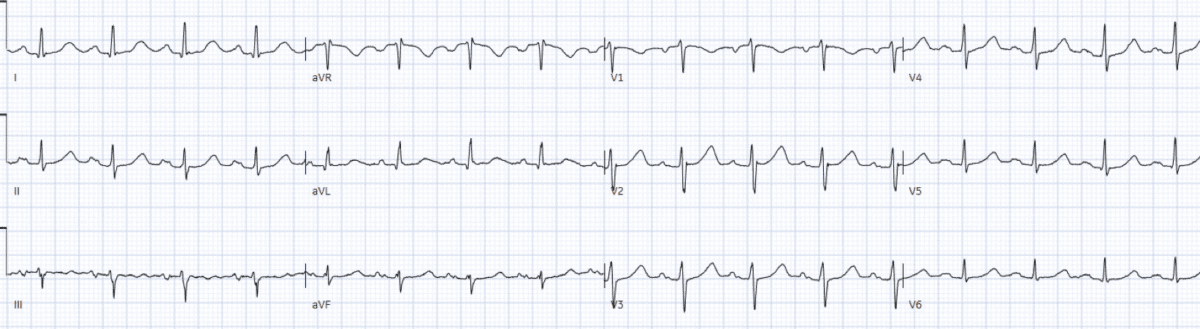 ECG interpretation in epigastric pain, vomiting | ECG Cases