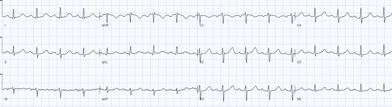 ECG interpretation in epigastric pain, vomiting | ECG Cases