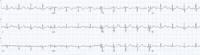 ECG interpretation in epigastric pain, vomiting | ECG Cases