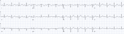 ECG interpretation in epigastric pain, vomiting | ECG Cases