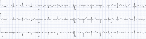 ECG interpretation in epigastric pain, vomiting | ECG Cases