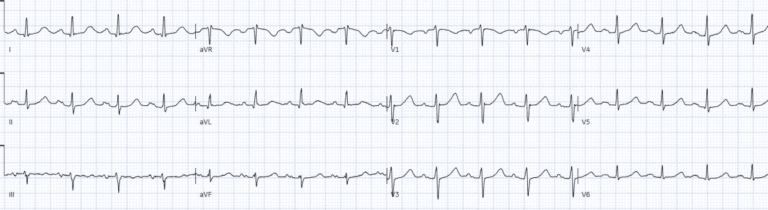 ECG interpretation in epigastric pain, vomiting | ECG Cases