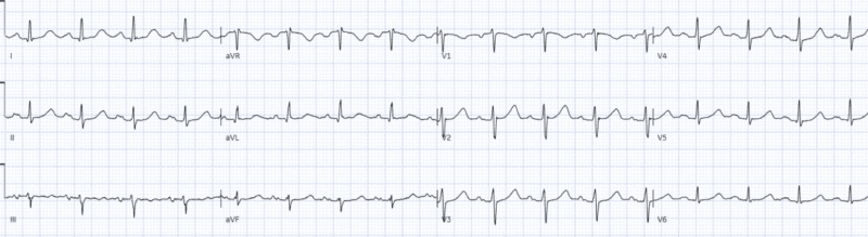 ECG interpretation in epigastric pain, vomiting | ECG Cases