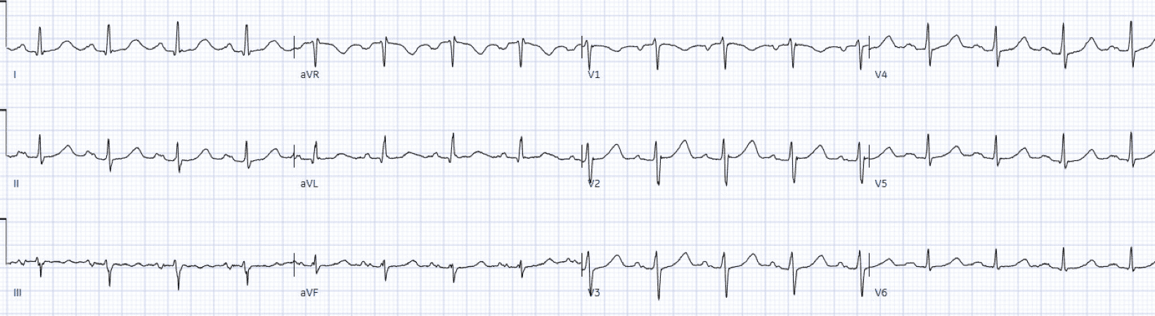 ECG interpretation in epigastric pain, vomiting | ECG Cases