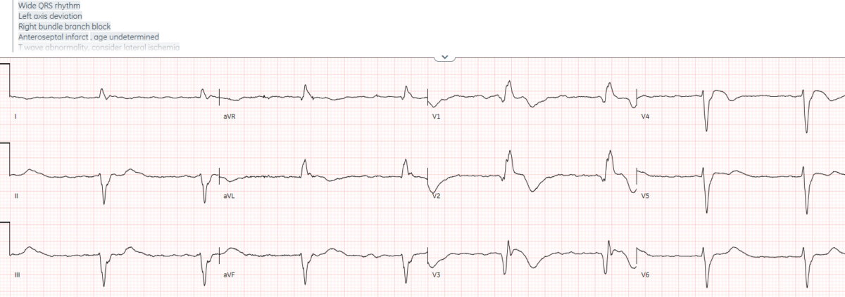 ECG interpretation in epigastric pain, vomiting | ECG Cases