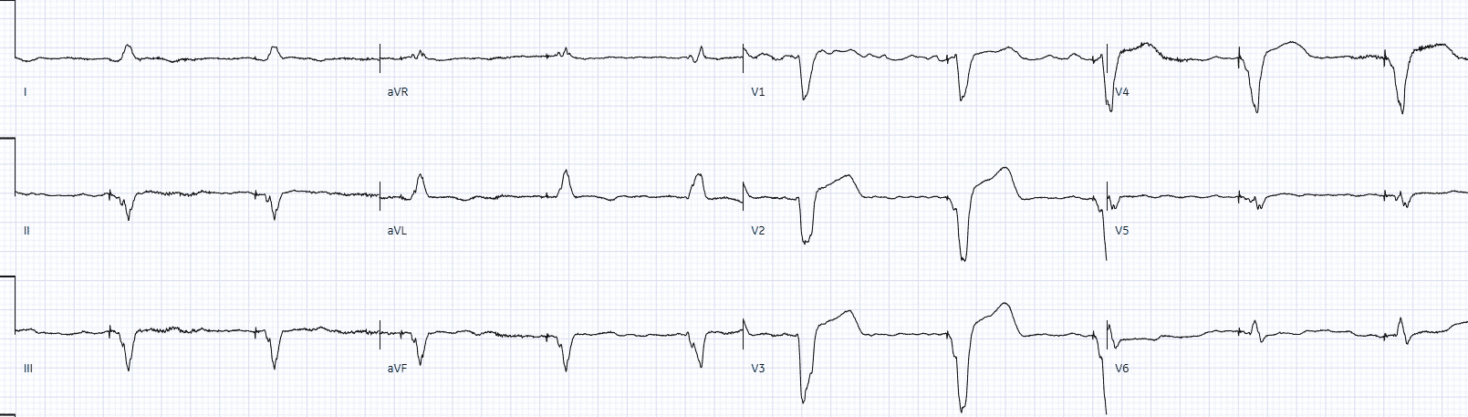 ECG interpretation in epigastric pain, vomiting | ECG Cases