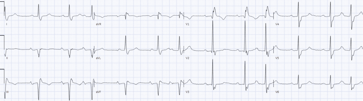 ECG in Weakness and Neurological symptoms | ECG Cases | EM Cases