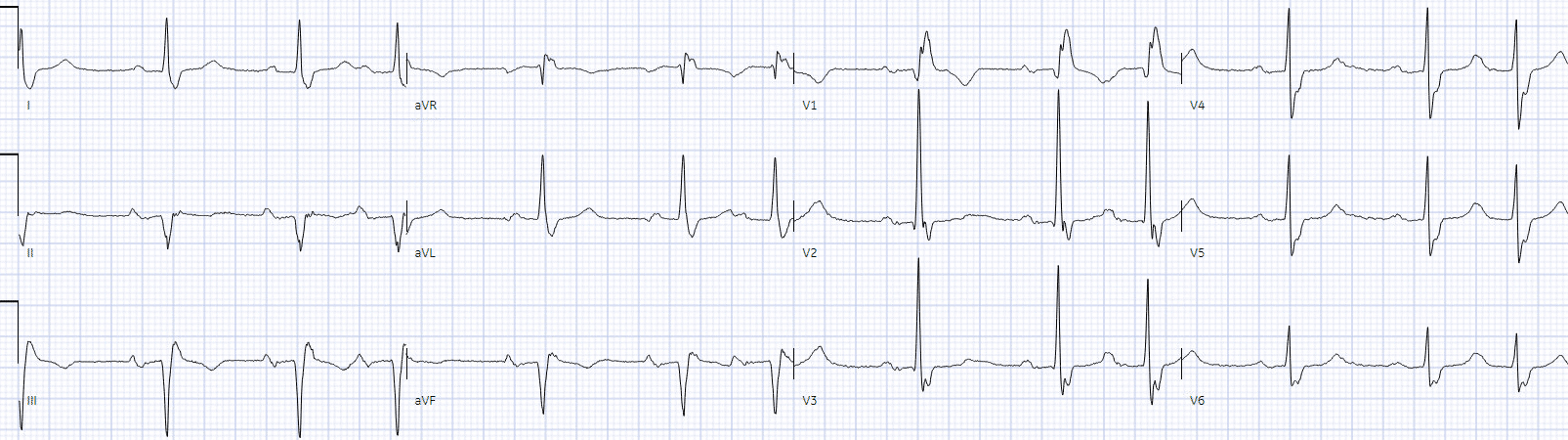 ECG in Weakness and Neurological symptoms | ECG Cases | EM Cases