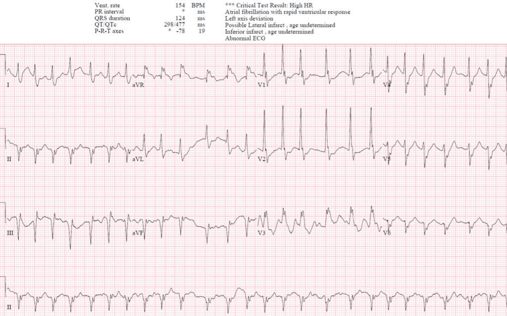 ECG in Weakness and Neurological symptoms | ECG Cases | EM Cases