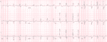 ECG in Weakness and Neurological symptoms | ECG Cases | EM Cases