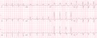 ECG in Weakness and Neurological symptoms | ECG Cases | EM Cases