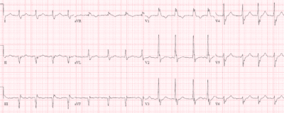 ECG in Weakness and Neurological symptoms | ECG Cases | EM Cases