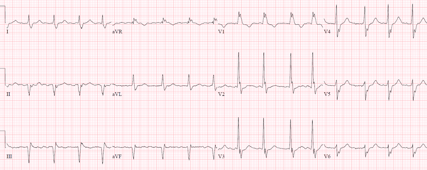 ECG in Weakness and Neurological symptoms | ECG Cases | EM Cases