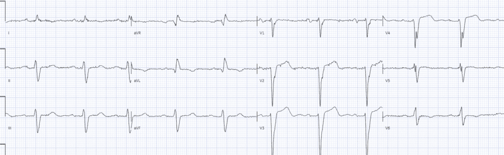 ECG in Weakness and Neurological symptoms | ECG Cases | EM Cases