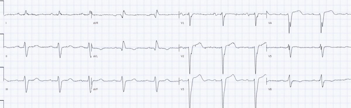 ECG in Weakness and Neurological symptoms | ECG Cases | EM Cases