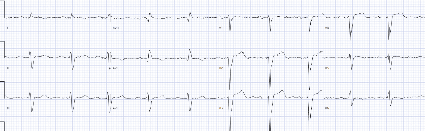 ECG in Weakness and Neurological Symptoms - האיגוד הישראלי לרפואה דחופה